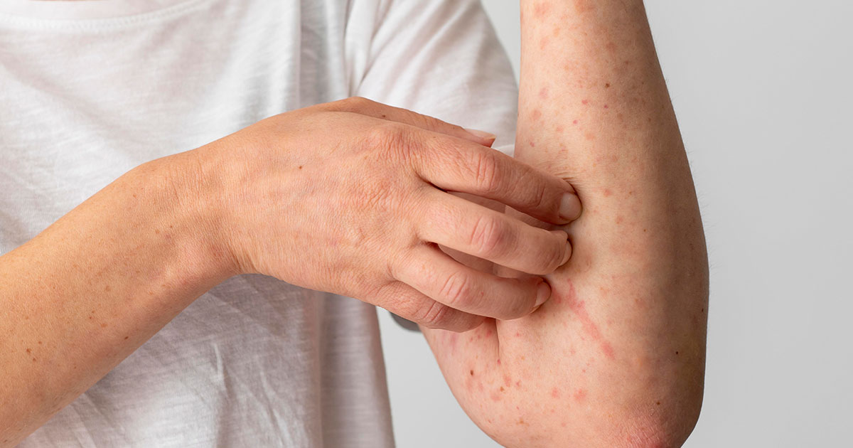 Έκζεμα – Δερματίτιδα – Optimum Dermatology