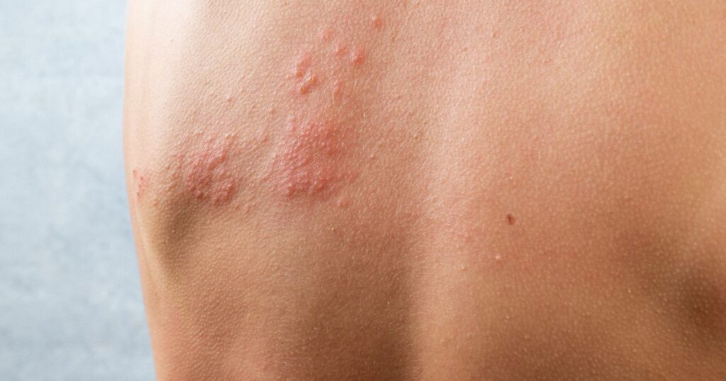 Λοιμώξεις Δέρματος – Optimum Dermatology